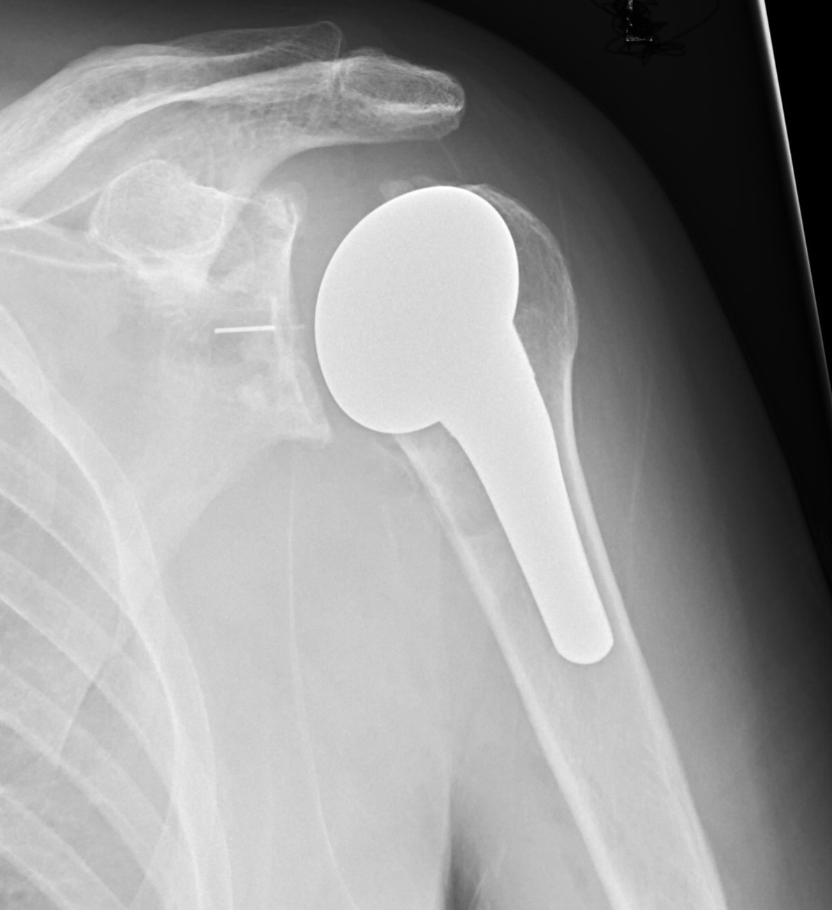 Shoulder Joint Arthritis